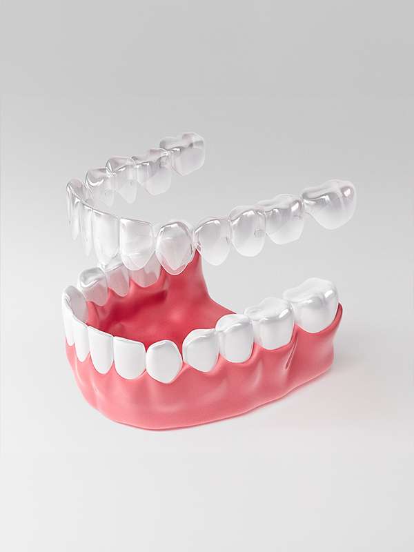 Invisalign | Invisible Braces | Best Invisalign in Calicut